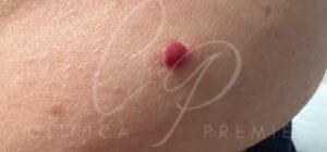 Angiomas adquiridos- ¿Que son y como se pueden tratar?