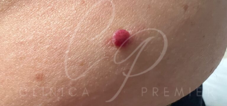 Angiomas adquiridos- ¿Que son y como se pueden tratar?