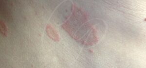 Pitiriasis rosada - ¿Que es y como se puede tratar?