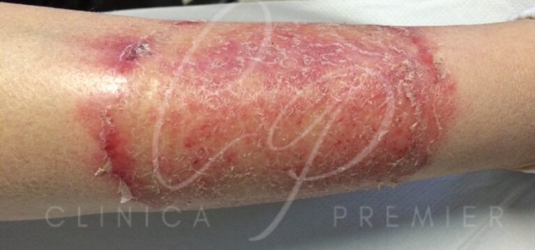 Tinea corporis (Tiña corporal): todo lo que debes saber