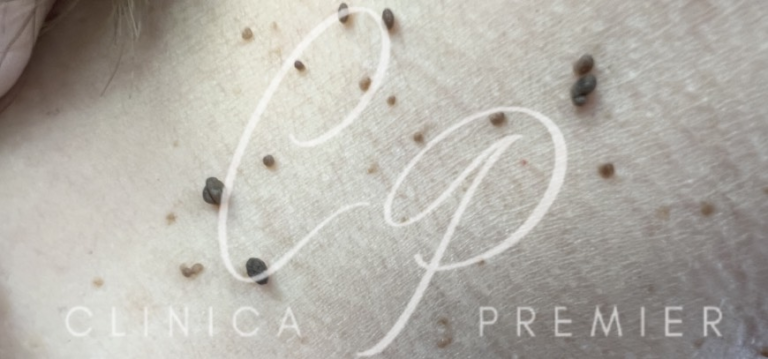 Acrocordones - ¿Que son y como se pueden tratar?