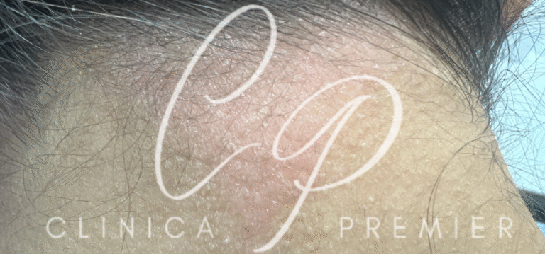 Neurodermatitis - ¿Que es y como se puede tratar?