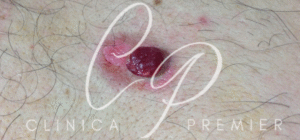 Granulomas piógenos - ¿Que son y como se puede tratar?